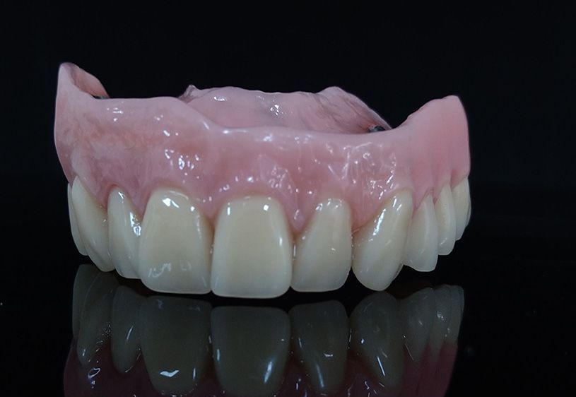 Abnehmbarer Zahnersatz vom Dentallabor in Wien | Teilprothesen